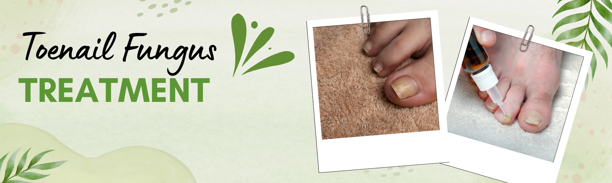 Toe Nail Fungus – La faby
